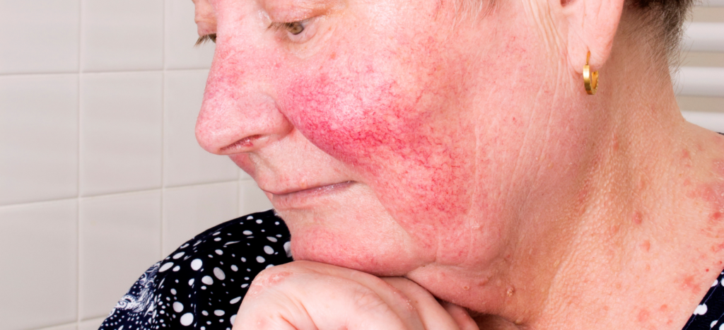 Rosacea: Causes, Symptoms, Treatments | Face Perfect Clinic